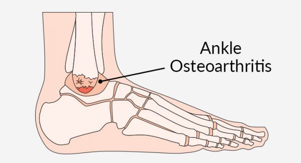 Ankle Osteoarthritis: Symptoms, Causes, Treatment By Ankle Braces
