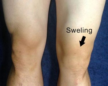 Geschwollenes Knie: Symptome, Ursachen, Behandlung durch Knieorthesen