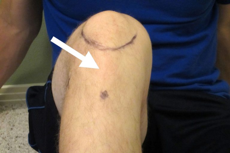 Patellar Tendon Pain: Symptoms, Causes, Treatment By Knee Braces