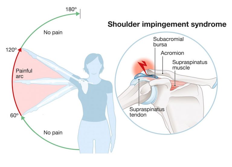 Schulterimpingement: Symptome, Ursachen, Behandlung durch Schulterstützen