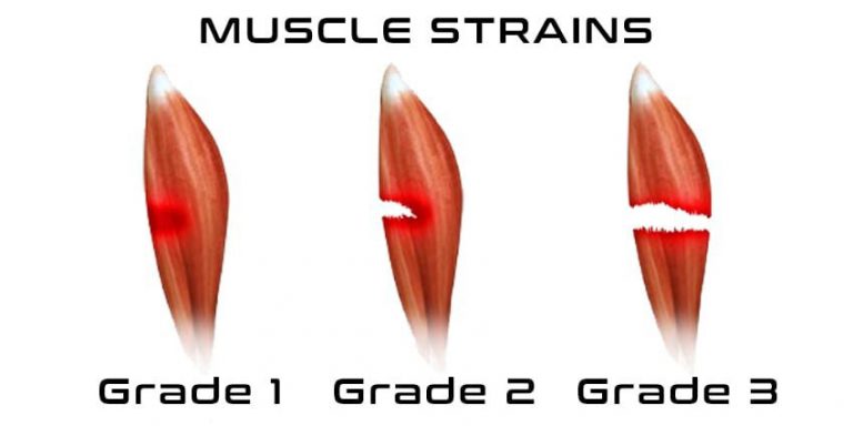 Pulled Back Muscle Treatment Symptoms Causes Treatment By Back Braces