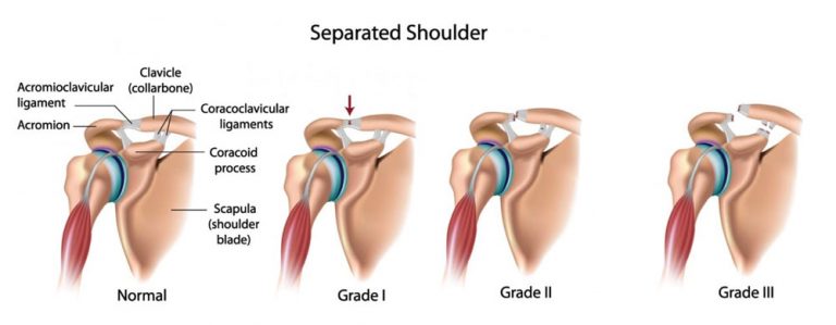 Shoulder Separation: Symptoms, Causes, Treatment By Shoulder Separation Braces