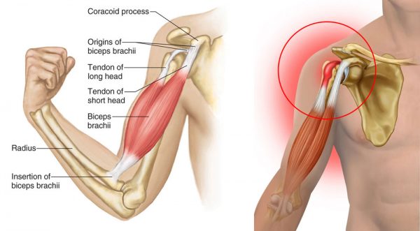 Biceps Tendonitis: Symptoms, Causes, Treatment By Shoulder Braces
