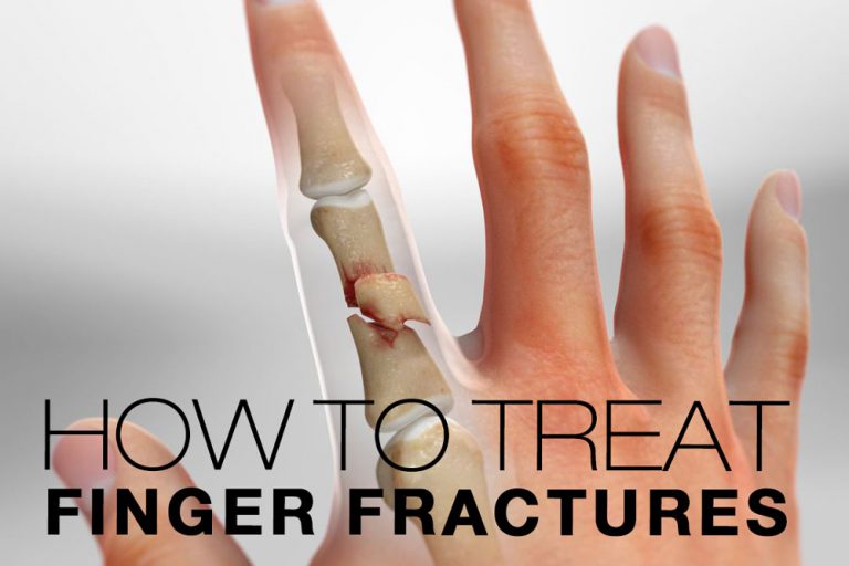 Finger Fractures: Symptoms, Causes, Treatment By WristT & Thumb Braces
