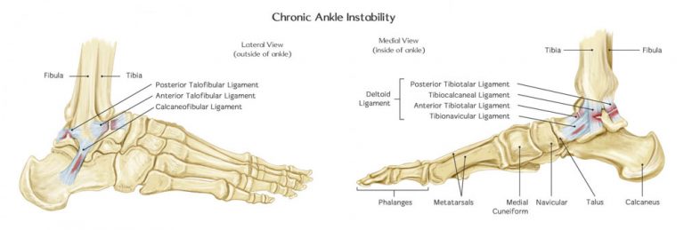 Ankle Instability: Symptoms, Treatment By Ankle Braces