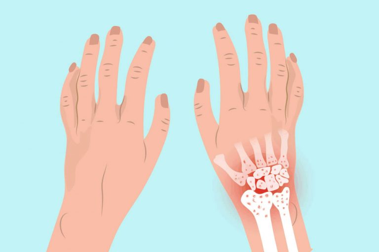 Arthritis am Handgelenk: Symptome, Ursachen, Behandlung durch ...
