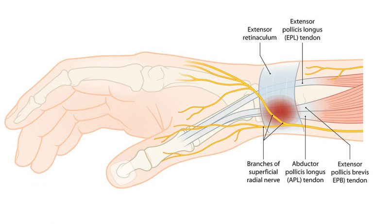 Syndrome de De Quervain : Symptômes, causes, traitement par les attelles de douleur au tendon du ...