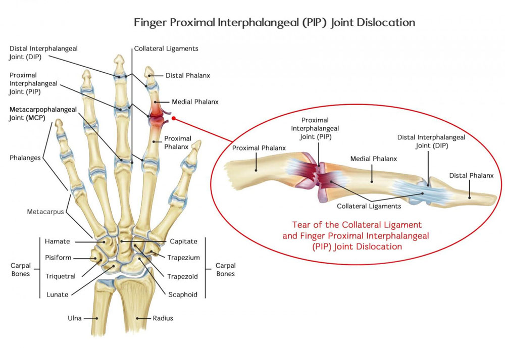 Dislocations Of The PIP Joint Symptoms Causes Treatment By Wrist