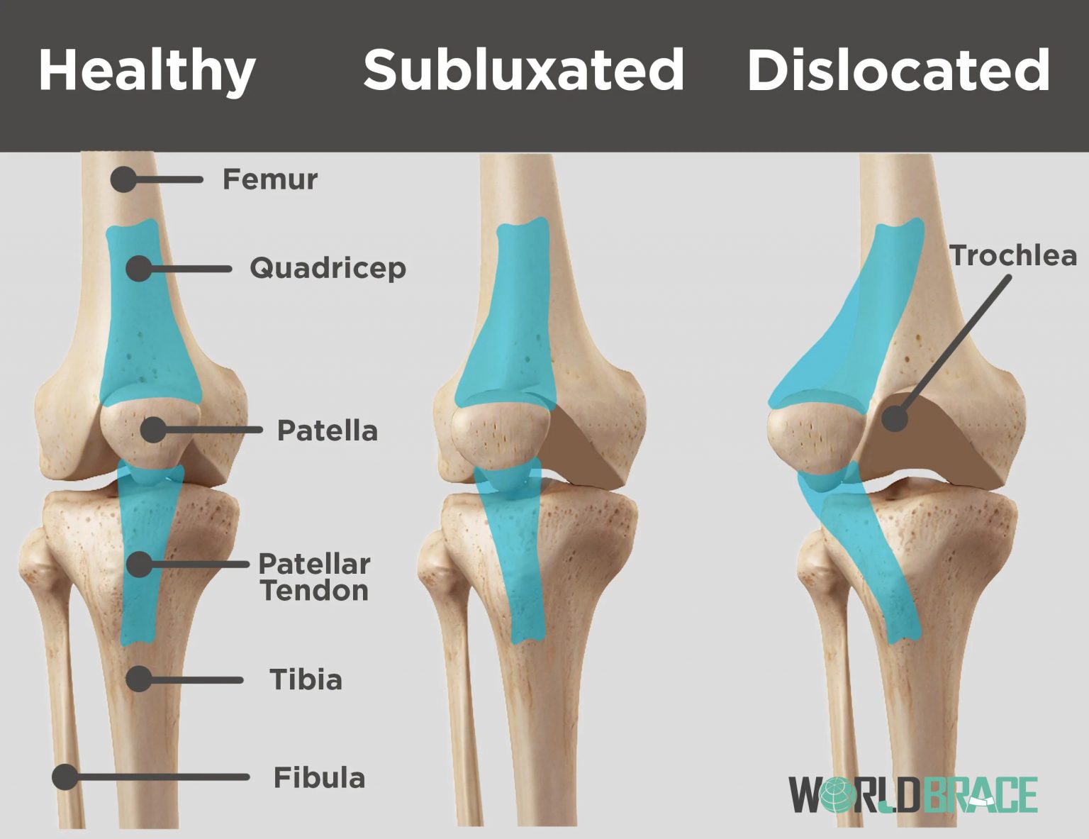 Subluxación patelar: ¿Qué es la subluxación en la rodilla? - WorldBrace