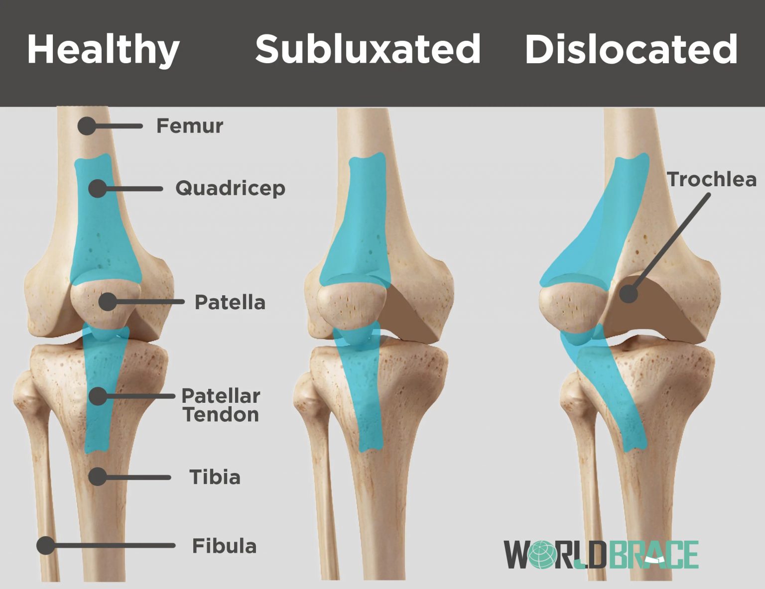 ¿Qué es la subluxación en la rodilla? - WorldBrace